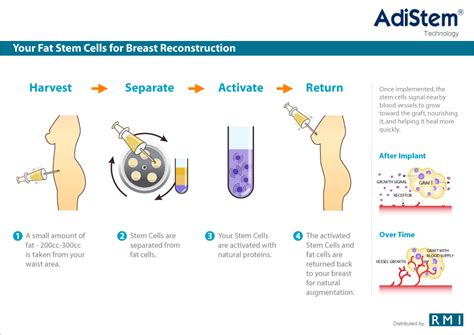 Stem Cell Therapy For Breast Reconstruction Breast Reconstruction