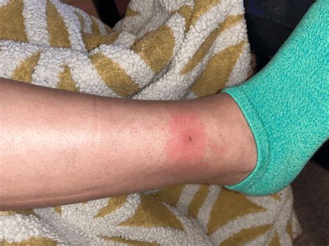 Spider Bites Vs Ant Bites Differences Pictures And Treatment Connors