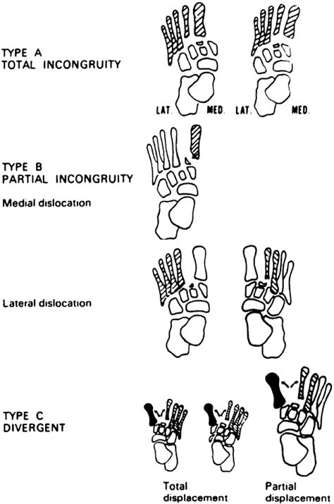 Do Columns Or Sagittal Displacement Matter In The Assessment And