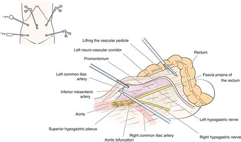 Laparoscopic Sigmoidectomy Abdominal Key