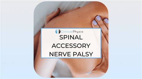 Spinal Accessory Nerve Palsy Clinical Physio Membership