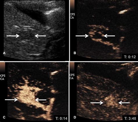 Peripheral Discontinuous Globular Enhancement A B Mode Image