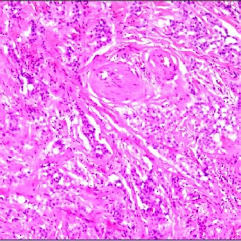 Pleural Pathology Malignant Mesothelioma Demonstrated Download