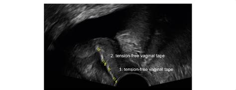 Dislocated Tension Free Vaginal Tape Correctly Placed Second Download Scientific Diagram
