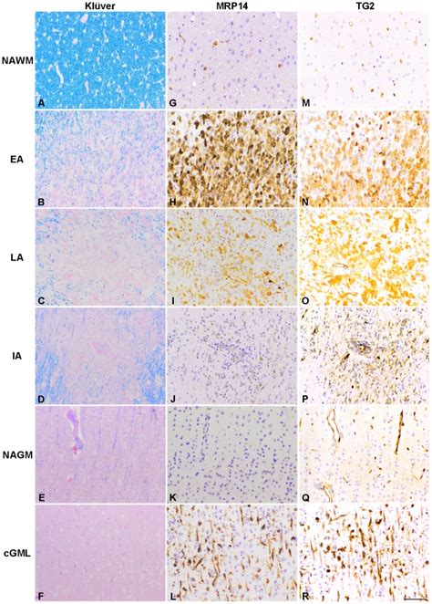 The Normal Appearing White Matter Nawm Shows An Intact Lfb Myelin Download Scientific Diagram