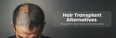 Hair Transplant Alternatives In Mumbai Non Surgical Hair Regrowth