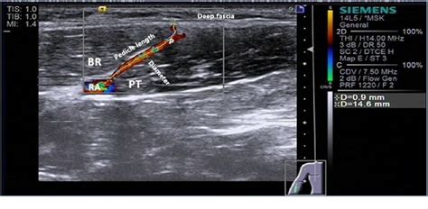 Table 2 From The Free Flap Based On A Single Proximal Perforator Of