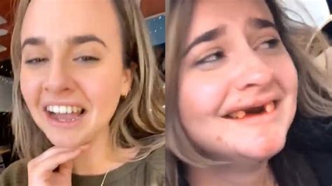 Mulher perde os dentes após tomar mimosas e vídeo viraliza