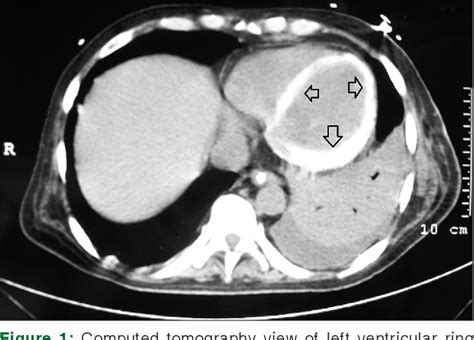Figure 1 From A Case Of Extensive Cardiac Calcification Semantic Scholar