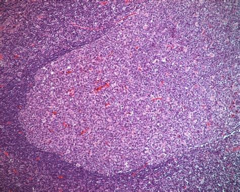 An Appendix With Low Amount Of Lymphoid Tissue Histological Assessment Download Scientific