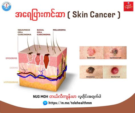 အရေပြားကင်ဆာ Skin Cancer Ministry Of Health Moh Myanmar
