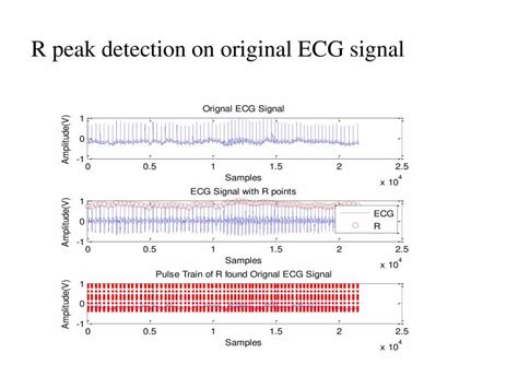 Optimal Ecg Data Compression For An E Health Transmission System