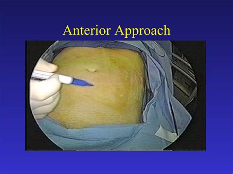 Laparoscopic Sigmoid Colon Resection For Diverticular Disease Ppt