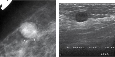 Benign Lump Male Breast At Donna Bradshaw Blog