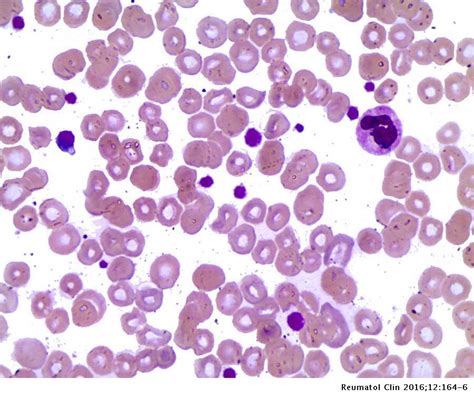 Xantomas Y Macrotrombocitopenia Sitosterolemia Es La Respuesta Reumatología Clínica