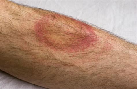What Lyme Disease Looks Like