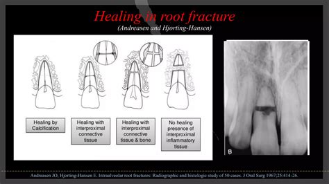 Management Of Tooth Fracture Pptx
