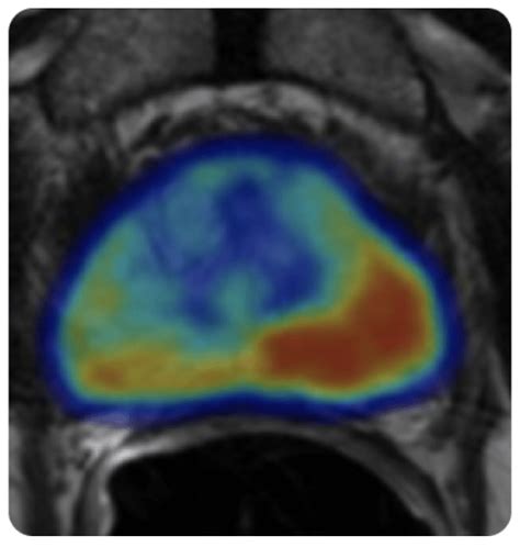 Prostate Cancer Detection Options Prostate Cancer Detection And Diagnosis With Mri And Ai For