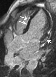Postpartum Cardiomyopathy Applied Radiology