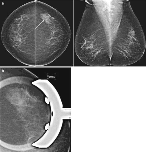 The Normal Breast SpringerLink
