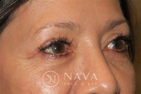 Browplasty Brow Lift Before And After Photos Nava Face And Eye