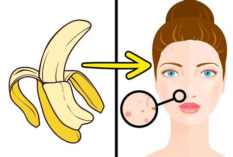 Treat Acne And Other Skin Conditions With Banana Peels