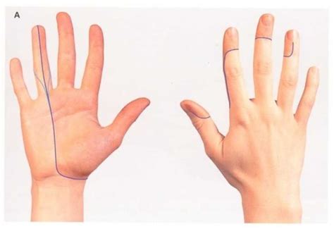 Mono Polyneuropathy Flashcards Quizlet