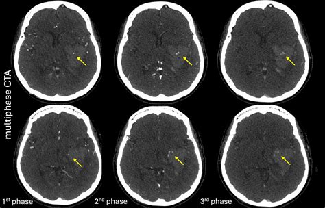 Spot Sign In Intracerebral Hemorrhage Critical Reappraisal And Future