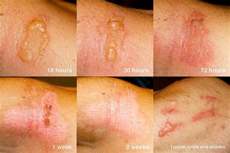 Poison Oak Rash Vs Poison Ivy Shop Sale