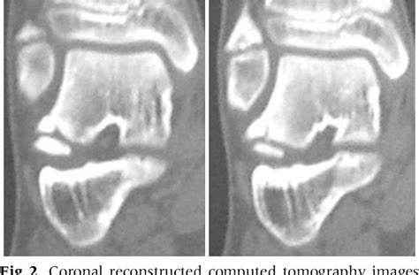 Figure 1 From Arthroscopic Excision Of Bone Fragments In A Neglected Fracture Of The Lateral