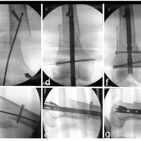 A Segmental Closed Fracture Of The Right Femur In A 33 Year Old Download Scientific Diagram