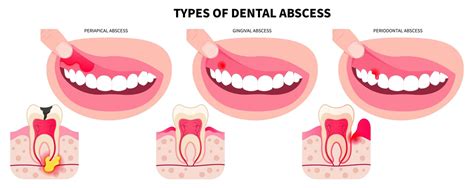 Periapical Abscess Treatment