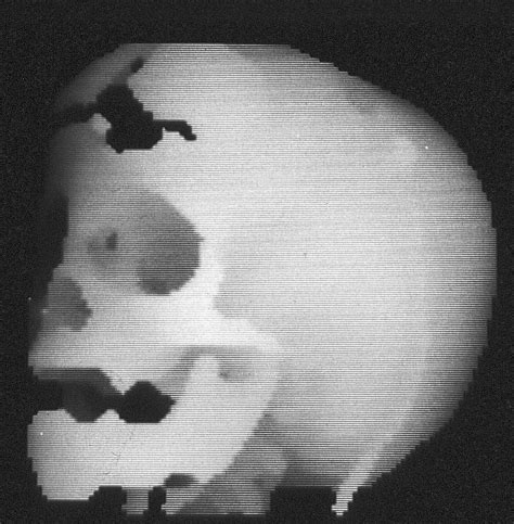 Encephalocele Hellenic Craniofacial Center