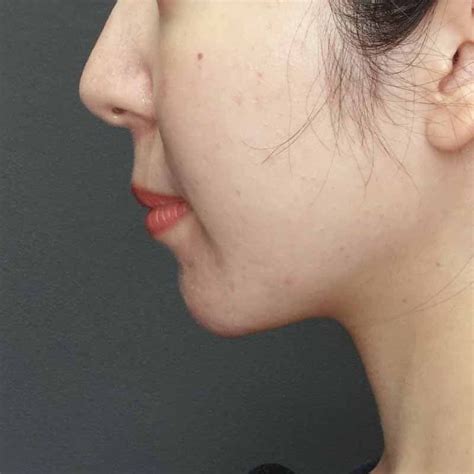 人中のボトックスの症例写真 Ι 執刀医：中村 芳帆 Ι 美容整形なら水の森美容クリニック