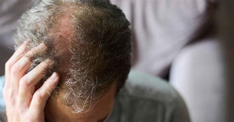 What Is Androgenetic Alopecia Pnw Hair Restoration