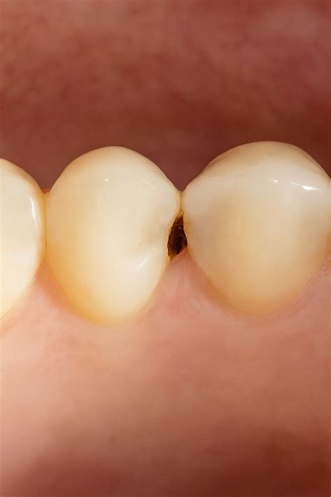 ¿qué Es Una Caries Interproximal Causas Diagnóstico Y Tratamiento Blog