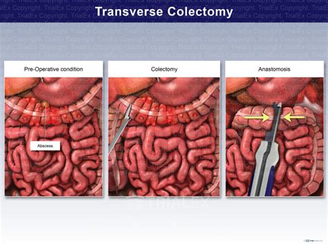 Transverse Colon Colectomy Trialexhibits Inc