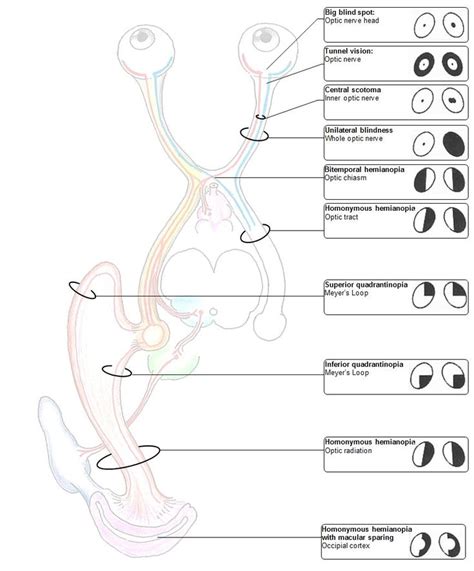Visual Fields And Lesions Of The Visual Pathways Cn Ii Deranged Physiology Neurology