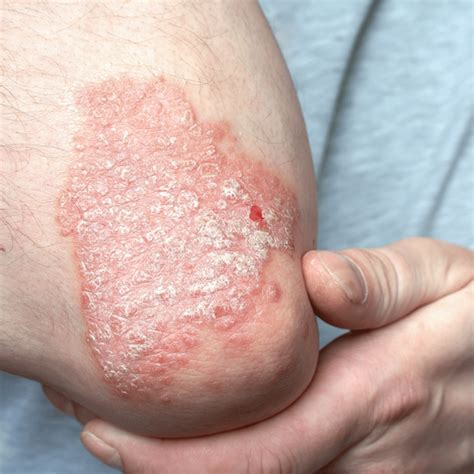 Treatment For Facial Psoriasis Vulgaris At Marjorie Lavalley Blog
