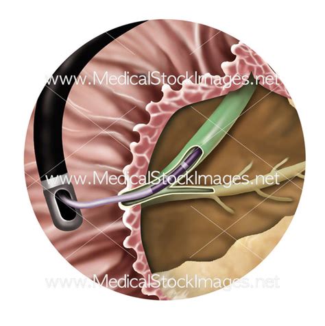 Endoscopic Retrograde Cholangiopancreatography Or Ercp Medical Stock
