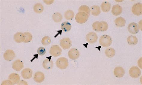Reticulocytes Cells And Smears