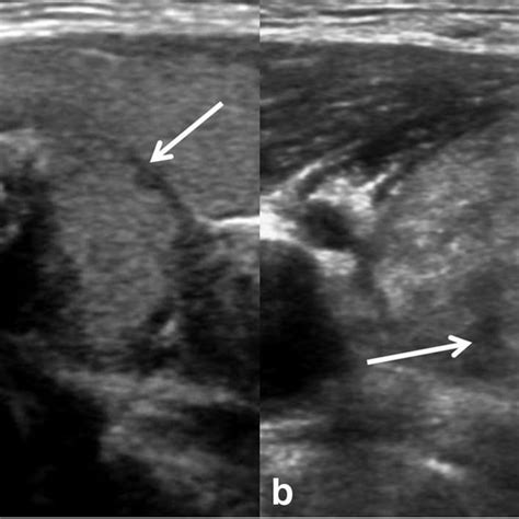 Thyroid Nodules With Heterogeneous Echotexture A Nodule With Download Scientific Diagram
