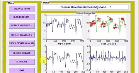 Detection Of Cardiac Disease From Ecg Signal Data Matlab Project With