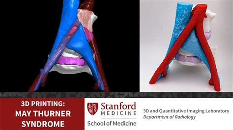 3d Printing May Thurner Syndrome