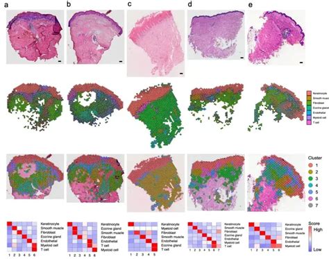 单细胞和空间测序确定了牛皮癣中角质形成细胞和成纤维细胞放大炎症反应的过程 知乎
