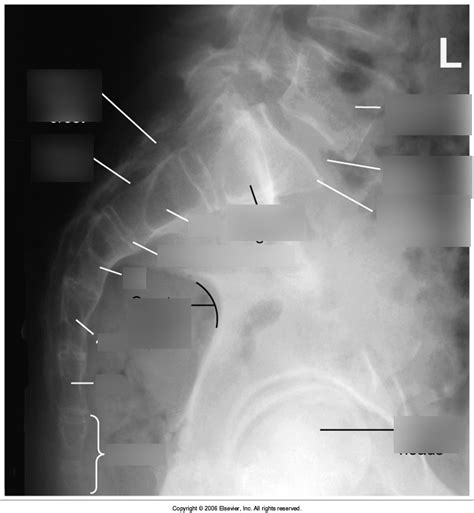 Pos 2 Left Lateral Sacrum Coccyx Diagram Quizlet