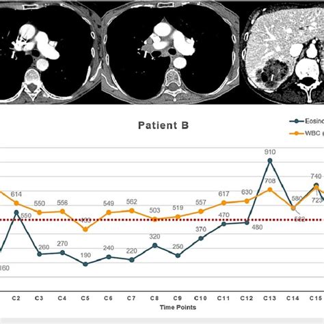 Patient A Colonoscopy Imaging Of The Appendiceal Orifice A Ileocecal Download Scientific