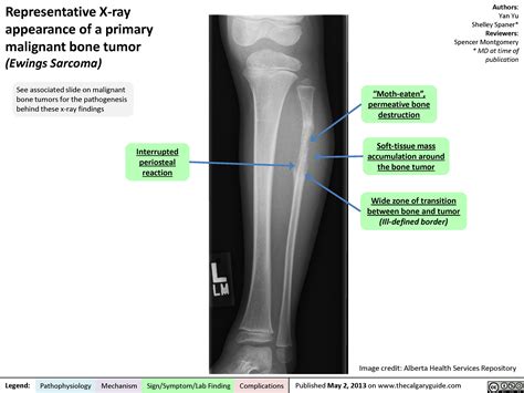 Reticulum Cell Sarcoma X Ray