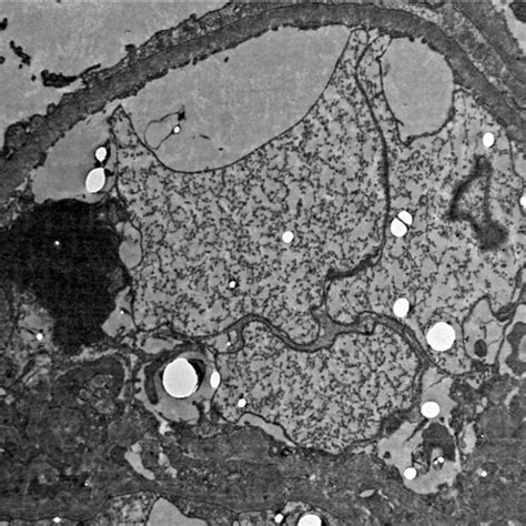 Case 1 Electron Microscopy Glomerulus Image Download Scientific