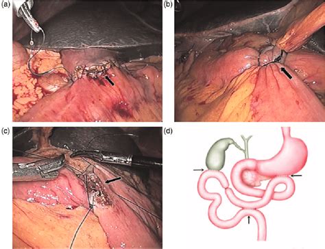 Laparoscopic Modified Loop Cholecystojejunostomy A Intraoperative